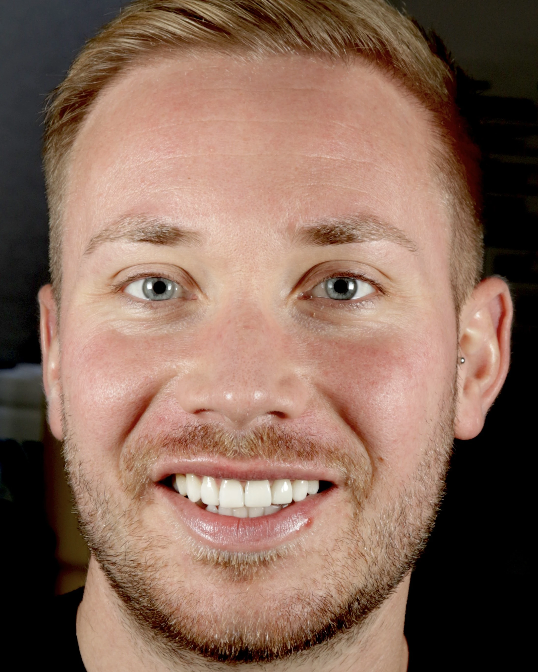 Alignar | Crafting Smiles with Teeth Straightening Clear Aligners
